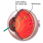 » Retinal Tear